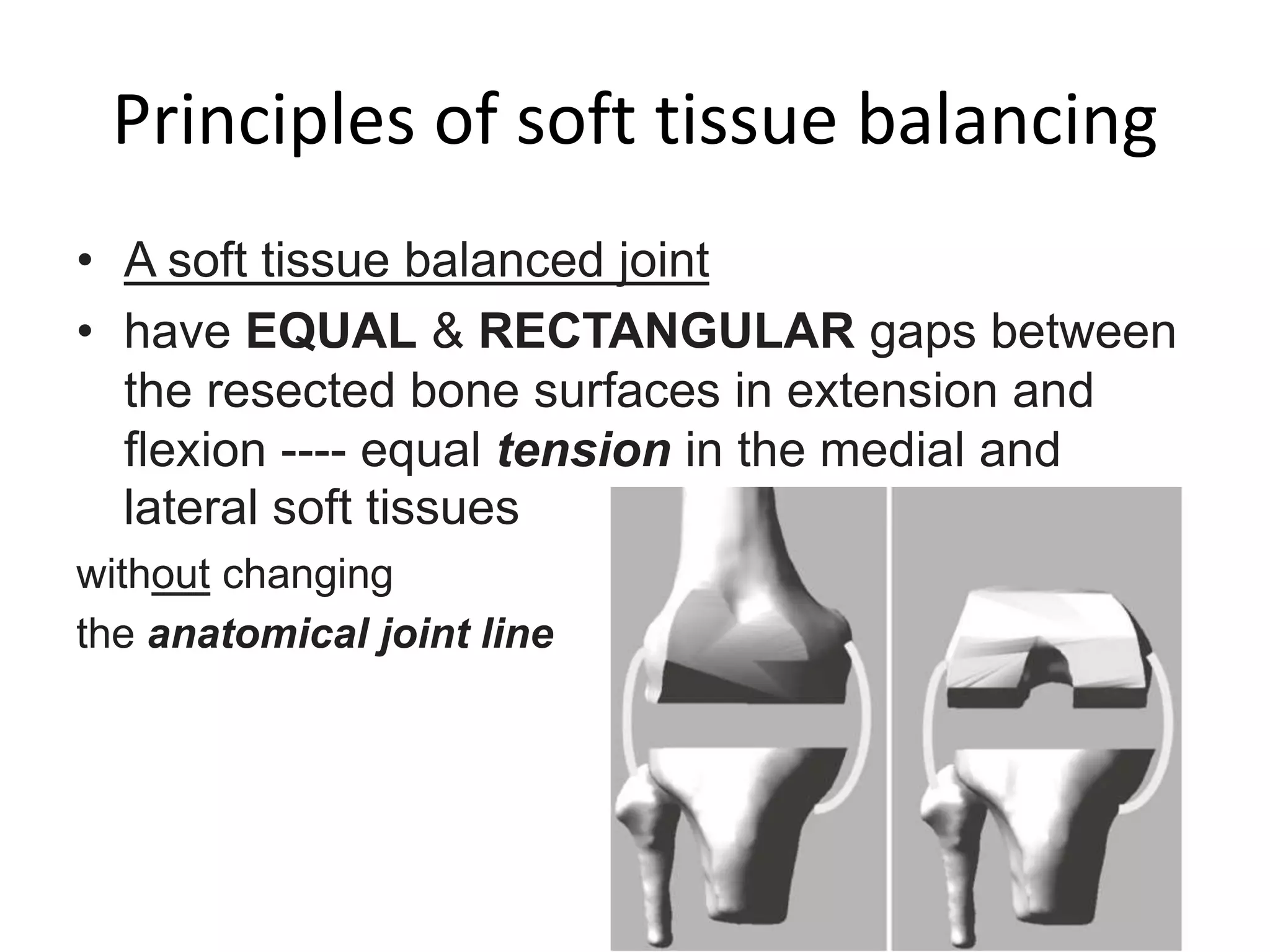 Soft Tissue Balancing in Primary Total Knee Arthroplasty | PPTX