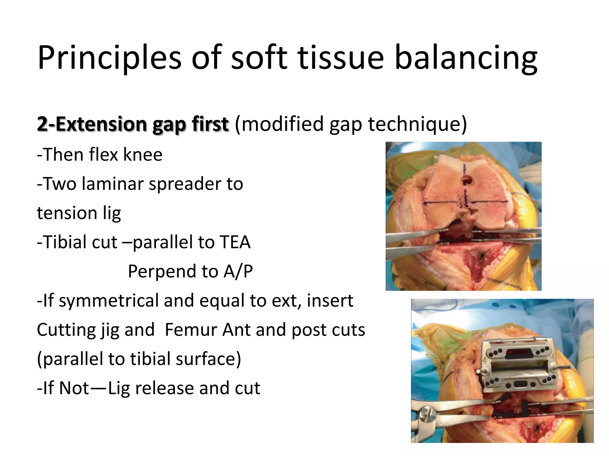 Soft Tissue Balancing in Primary Total Knee Arthroplasty | PPTX