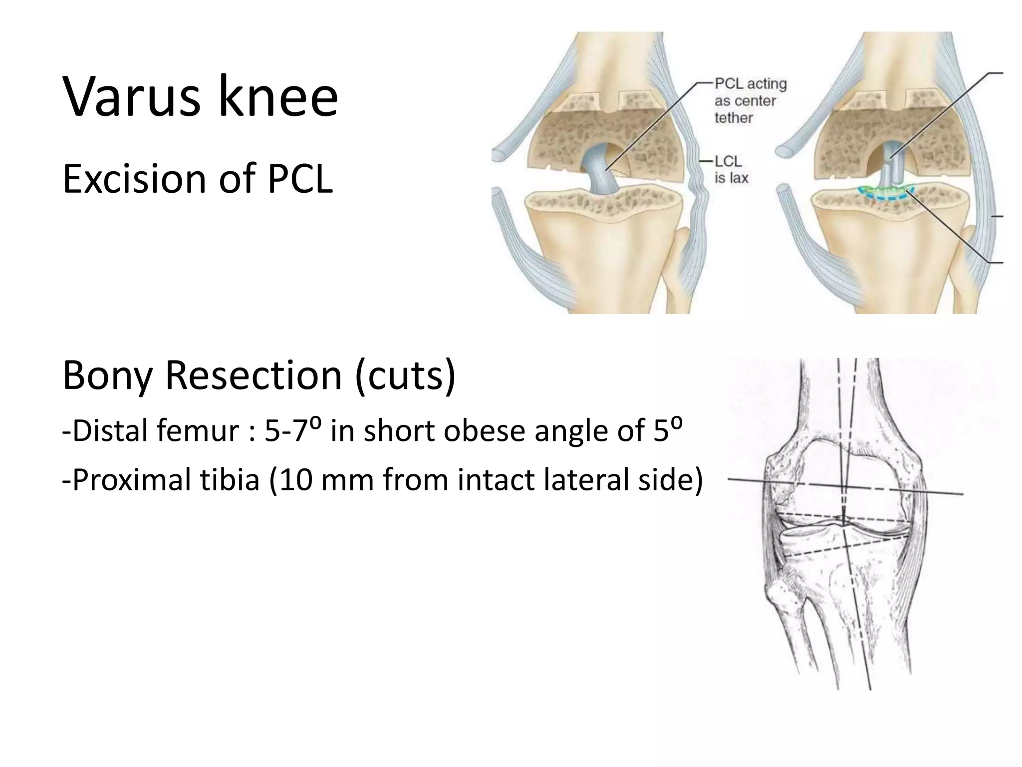 Soft Tissue Balancing in Primary Total Knee Arthroplasty | PPTX