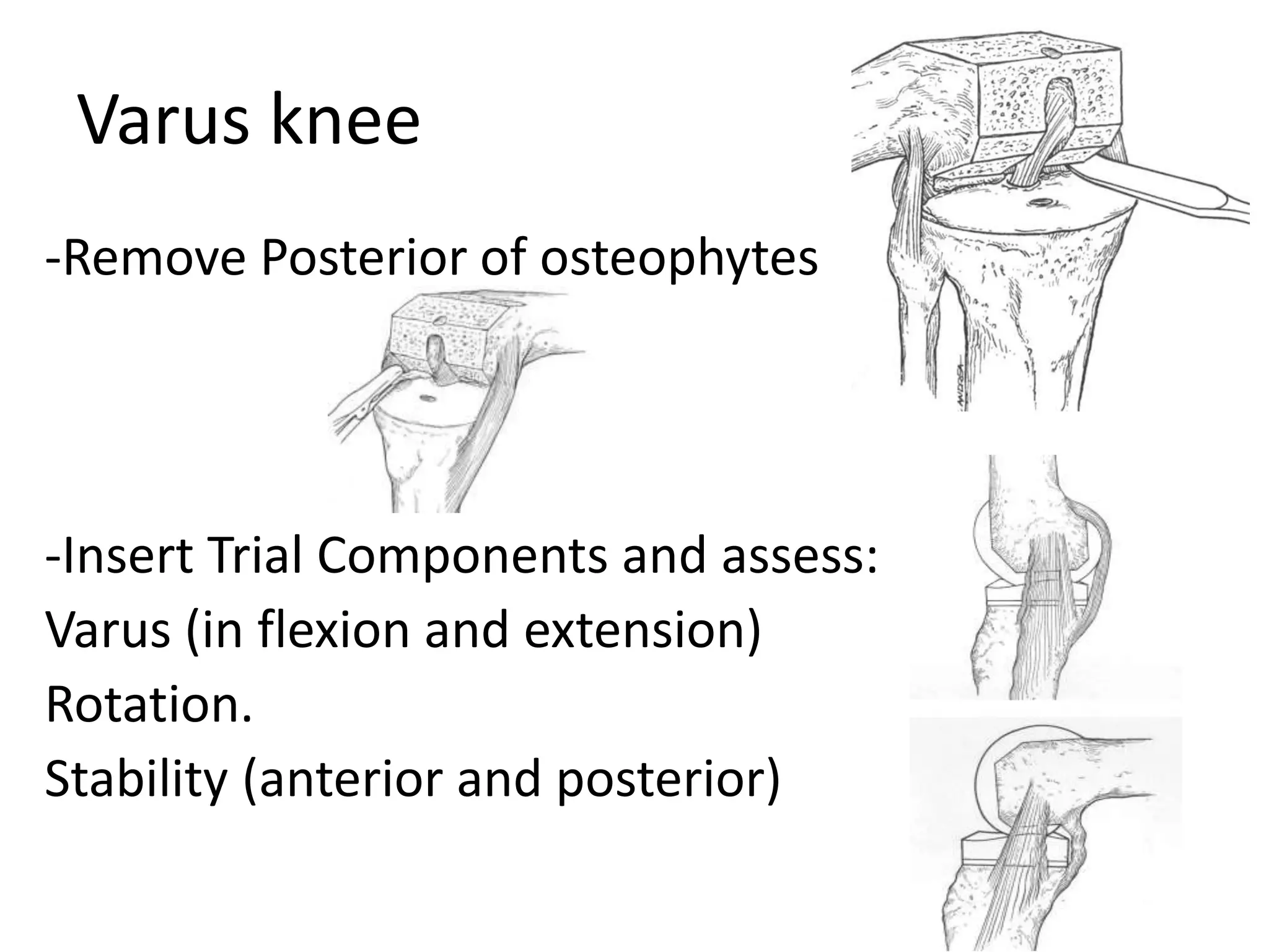 Soft Tissue Balancing in Primary Total Knee Arthroplasty | PPTX