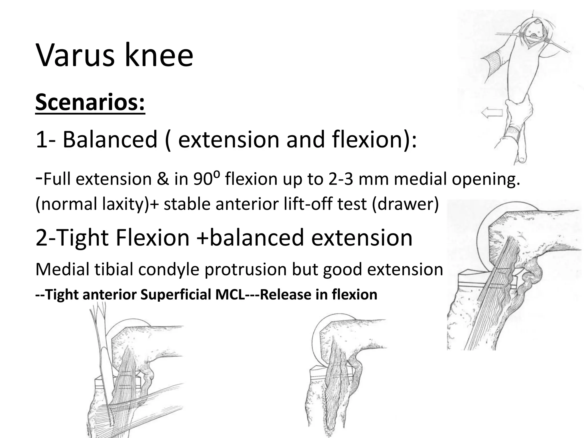 Soft Tissue Balancing in Primary Total Knee Arthroplasty | PPTX