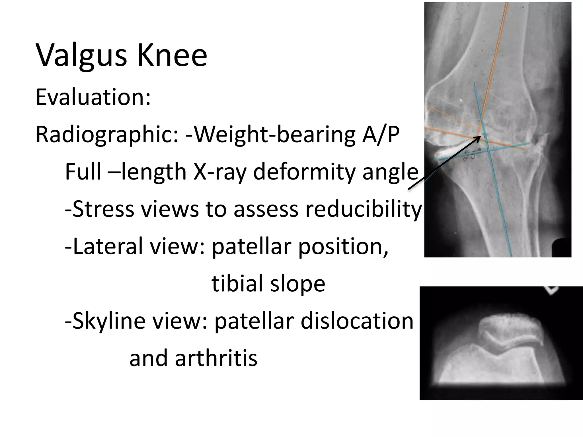 Soft Tissue Balancing in Primary Total Knee Arthroplasty | PPTX