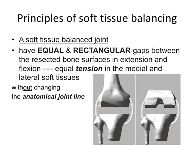 Soft Tissue Balancing in Primary Total Knee Arthroplasty | PPTX
