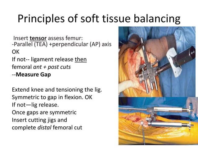 Soft Tissue Balancing in Primary Total Knee Arthroplasty | PPTX