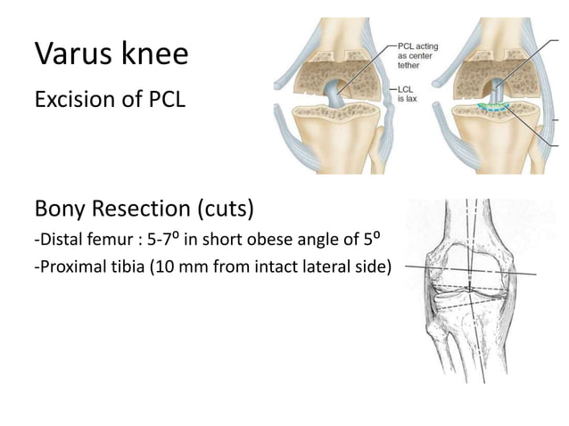Soft Tissue Balancing in Primary Total Knee Arthroplasty | PPTX