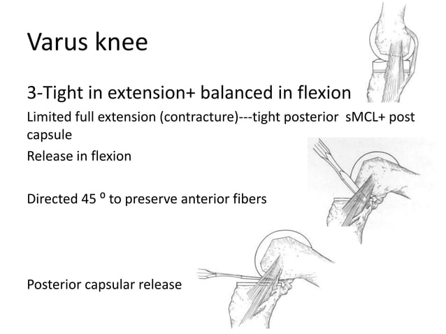Soft Tissue Balancing in Primary Total Knee Arthroplasty | PPTX