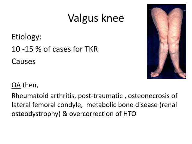 Soft Tissue Balancing in Primary Total Knee Arthroplasty | PPTX