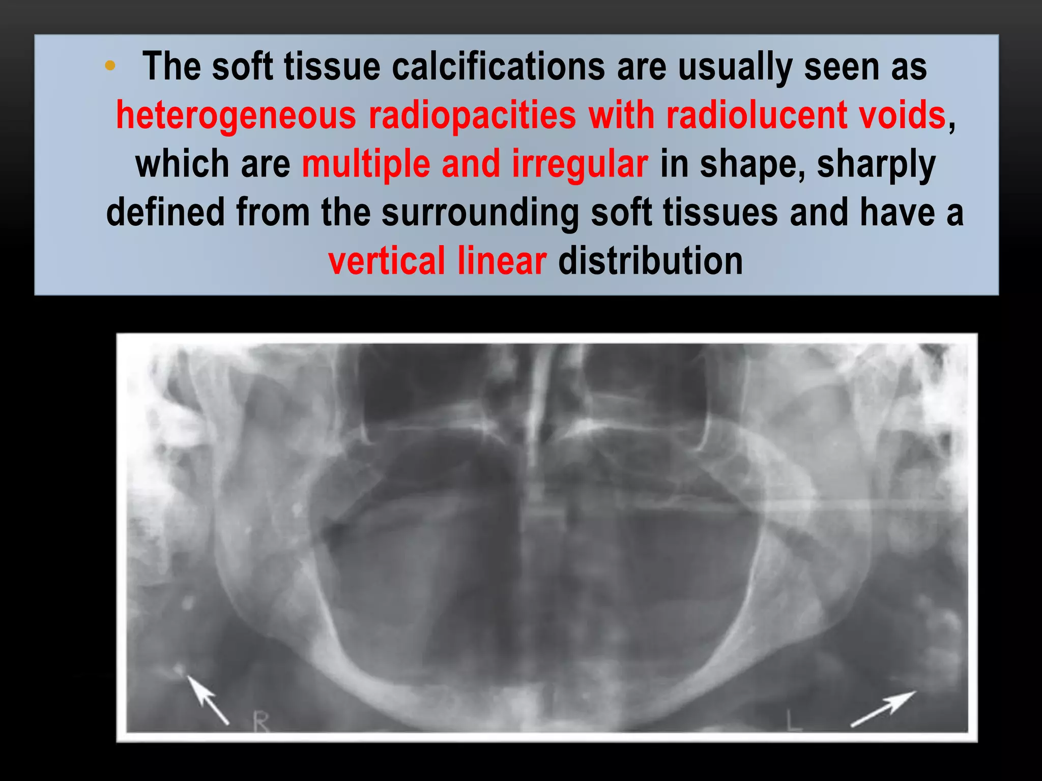 Soft tissue calcification orofacial region | PPTX