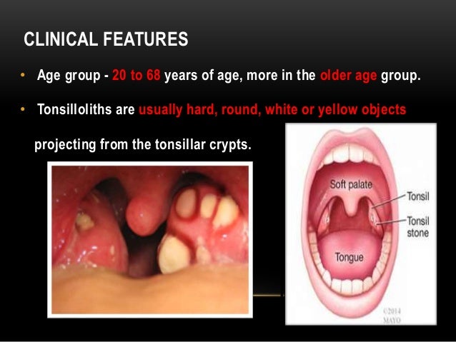Soft tissue calcification orofacial region