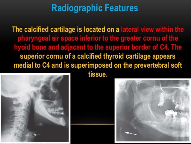 Thyroid Cartilage X Ray