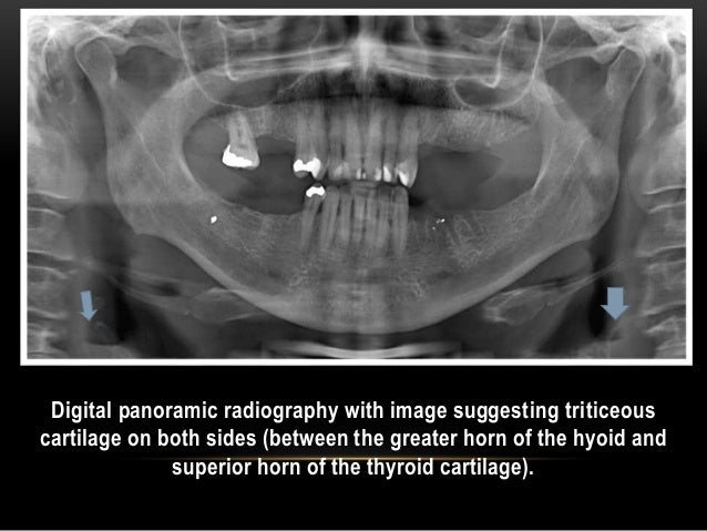 Soft tissue calcification orofacial region