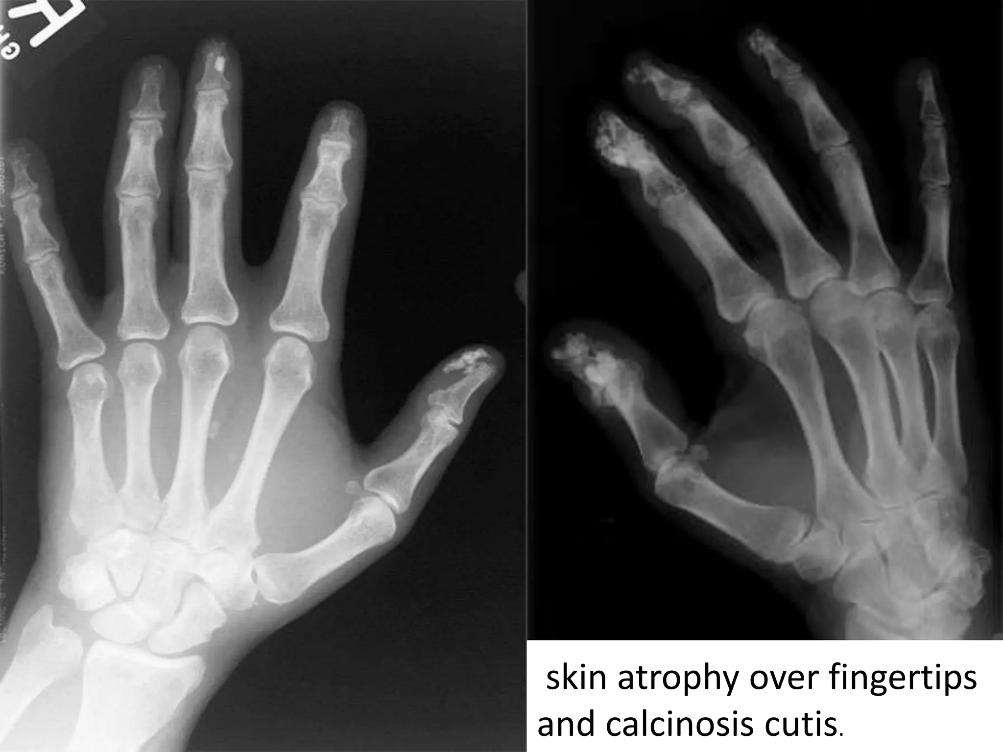 Soft tissue calcification | PPTX