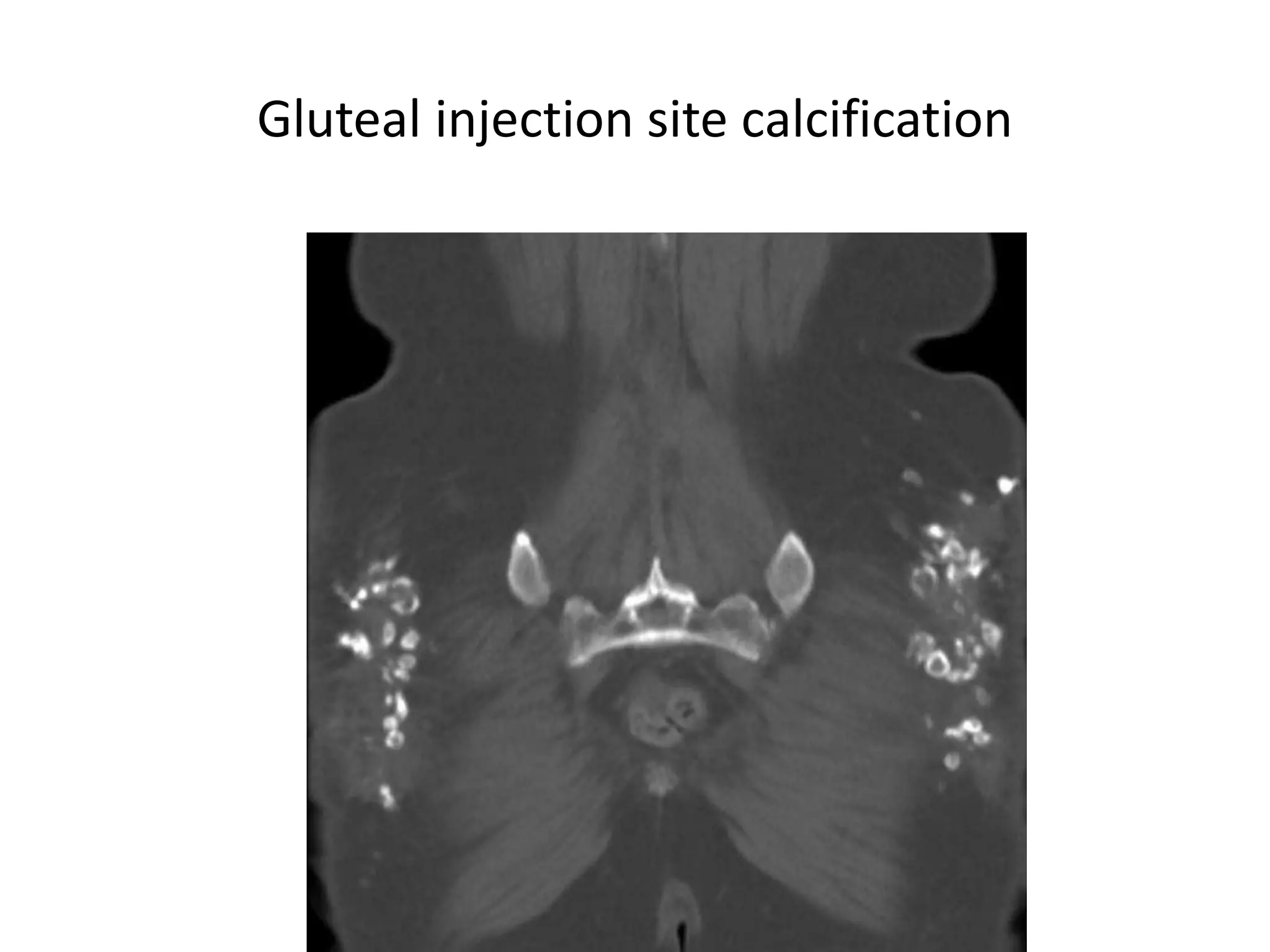 Soft tissue calcification | PPTX