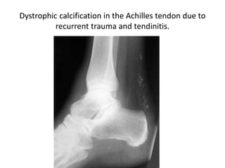 Soft tissue calcification | PPTX