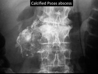 Soft tissue calcification | PPTX