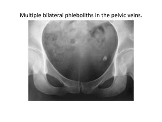 Calcification In The Veins