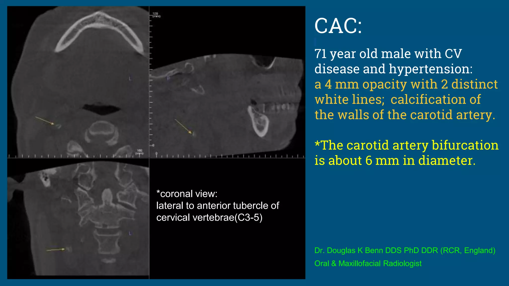 Soft tissue calcification in the neck | PPTX