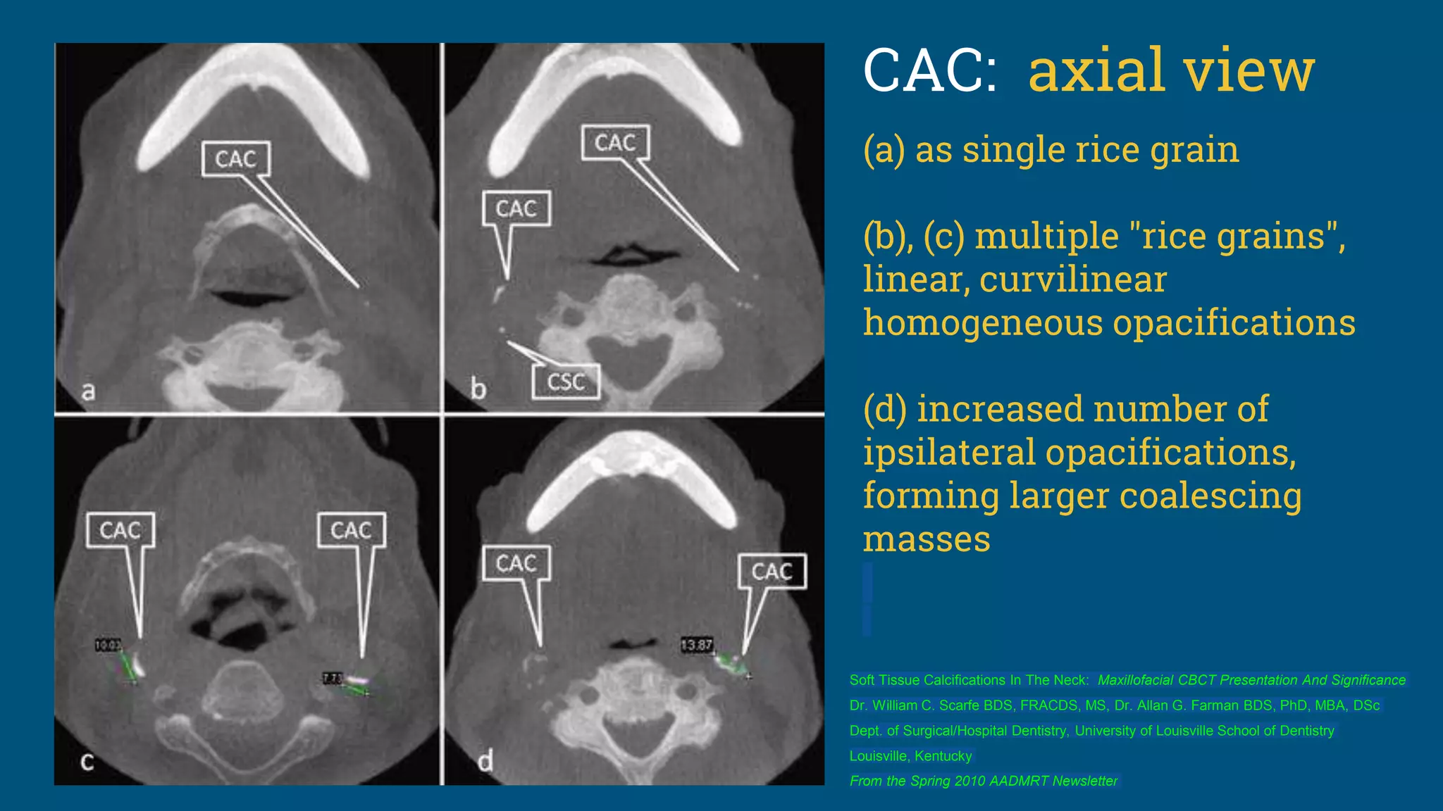 Soft tissue calcification in the neck | PPTX