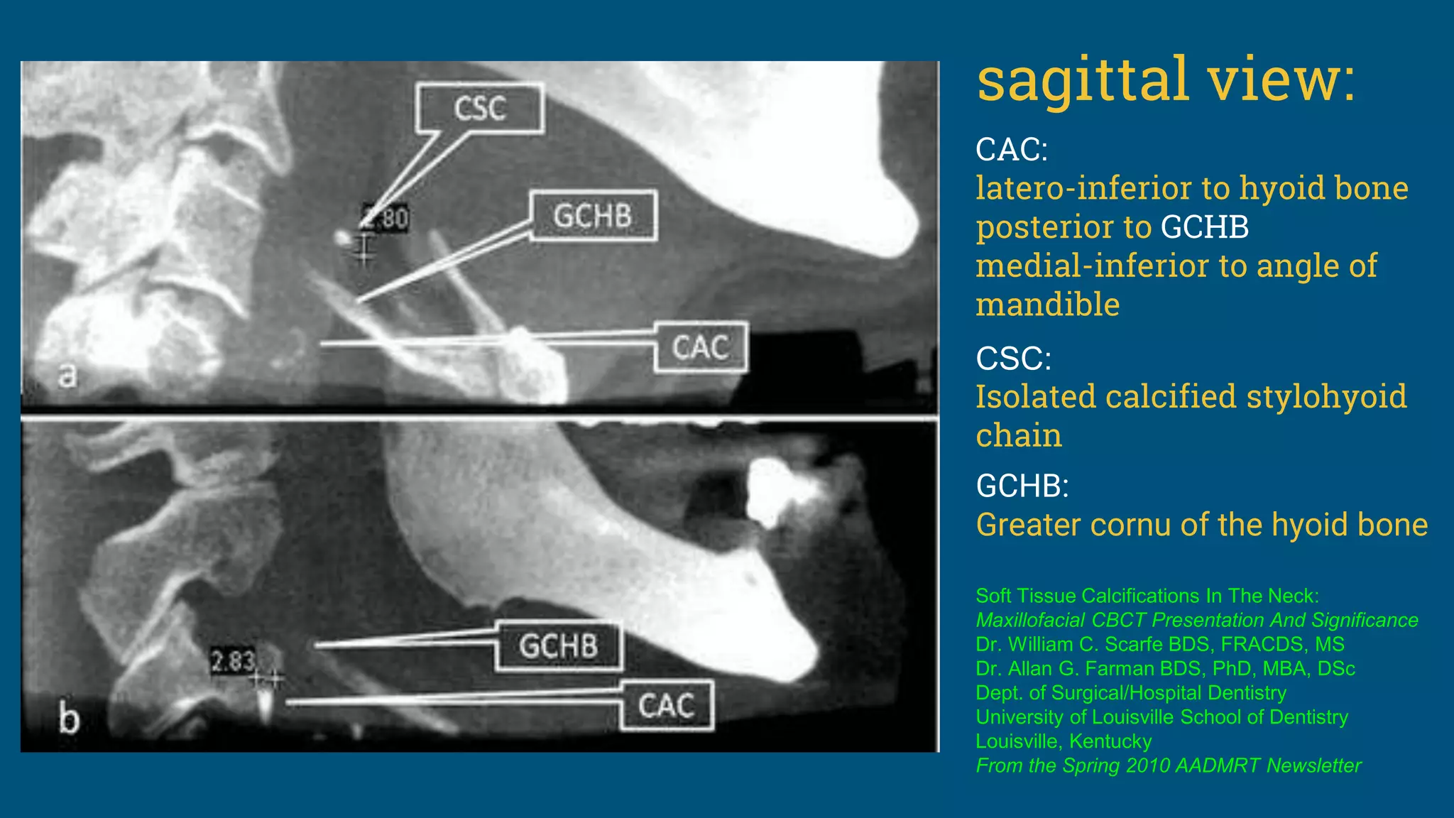 Soft tissue calcification in the neck | PPTX