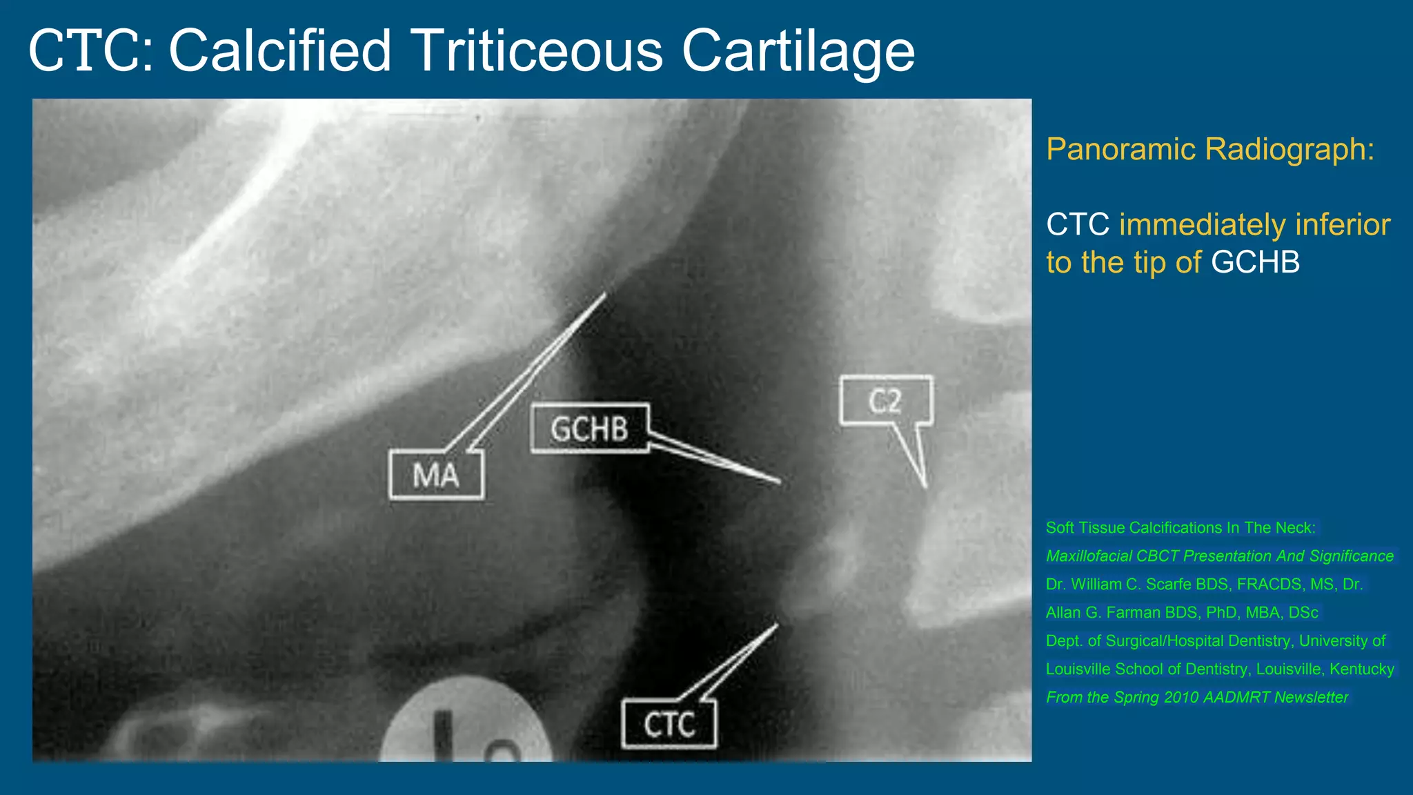 Soft tissue calcification in the neck | PPTX
