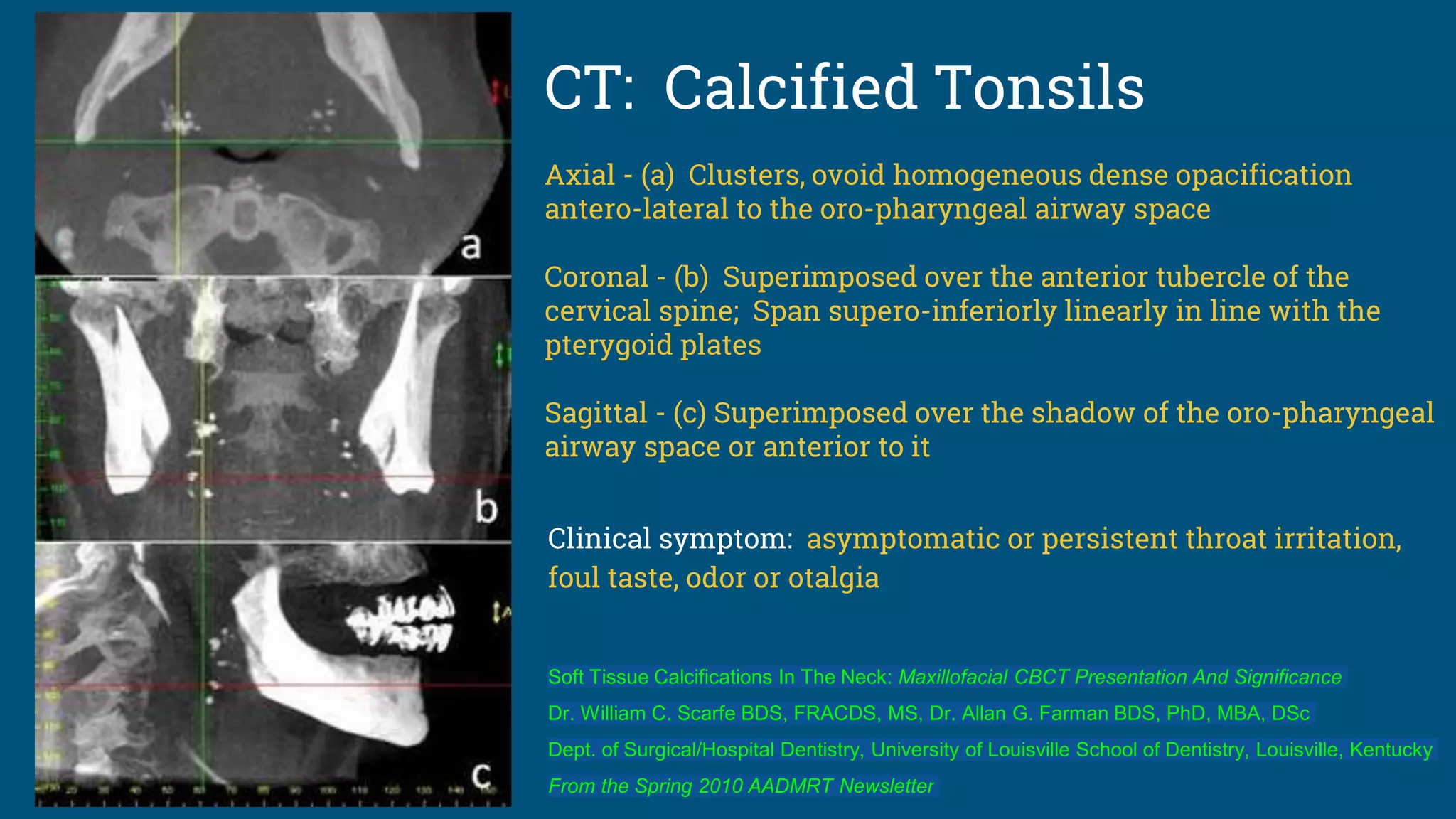Soft Tissue Calcification In The Neck Ppt