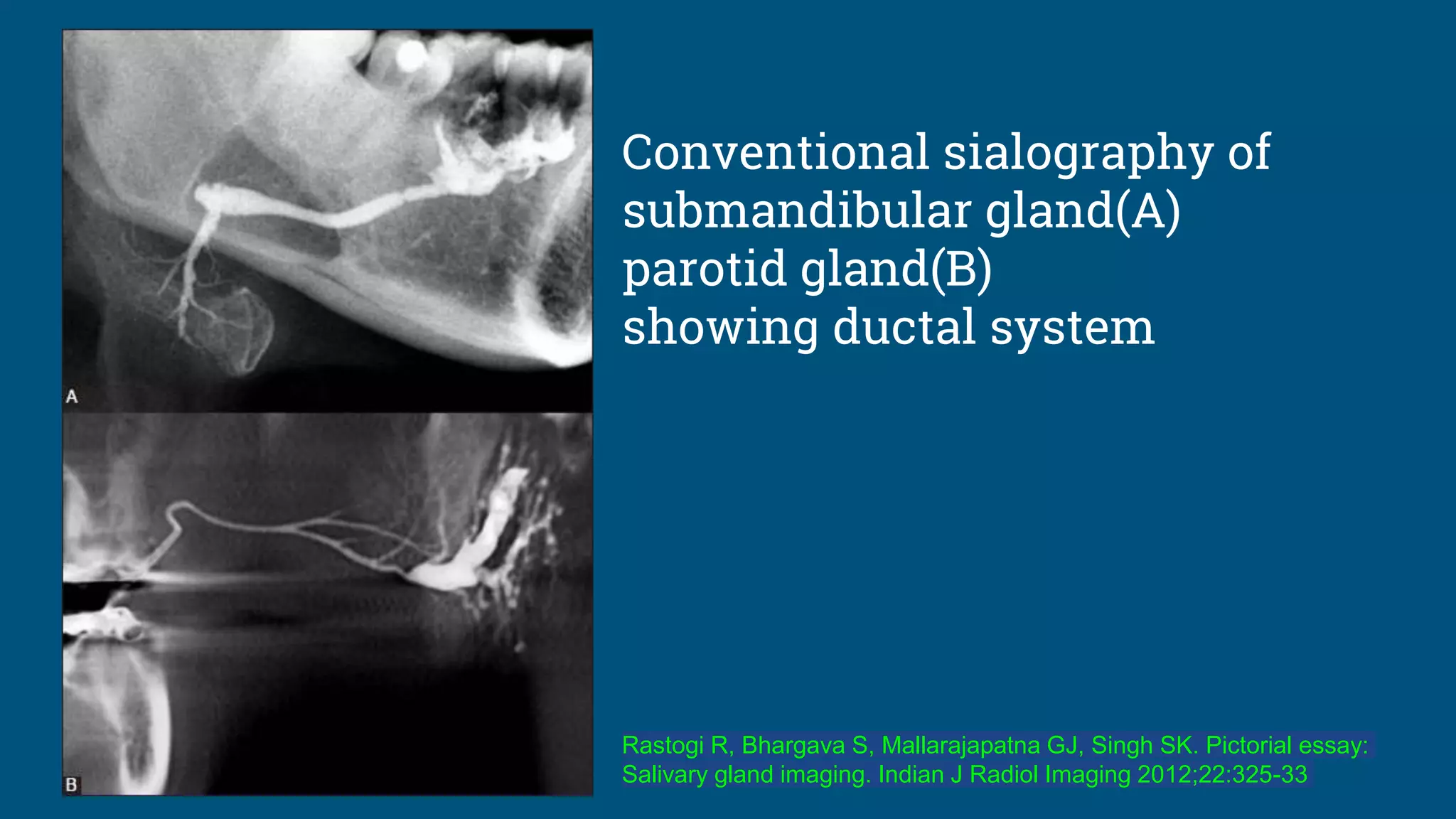 Soft tissue calcification in the neck | PPTX
