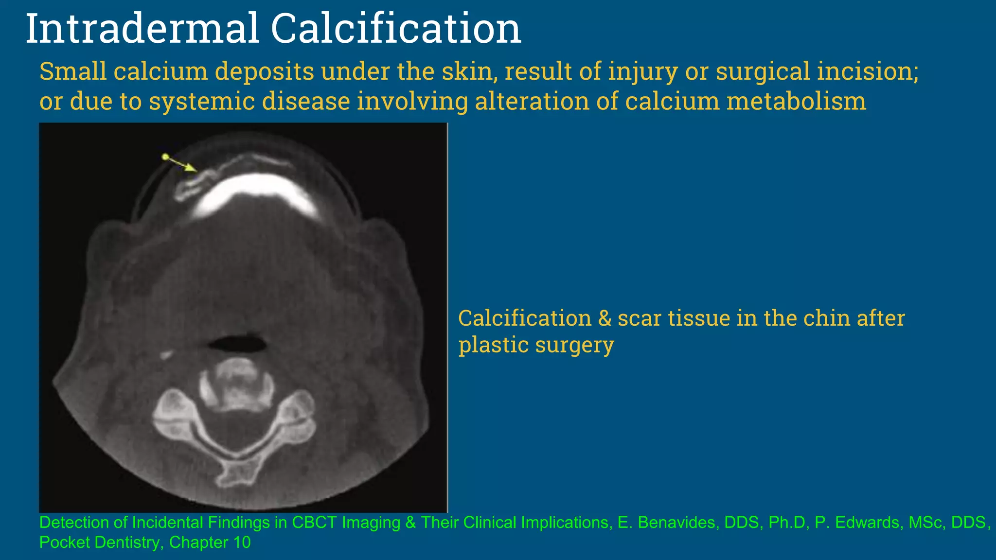 Soft tissue calcification in the neck | PPTX