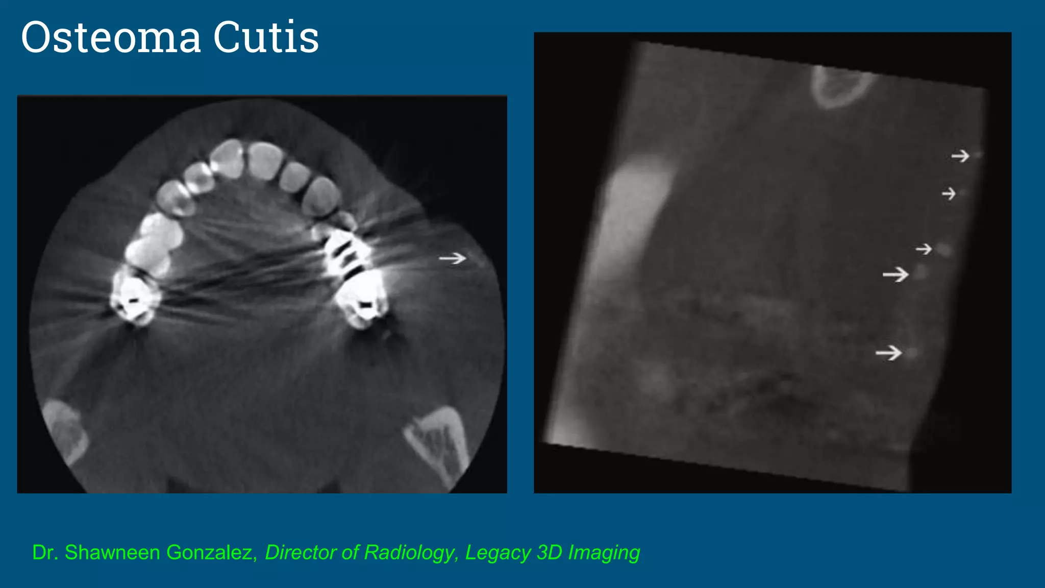 Soft tissue calcification in the neck | PPTX