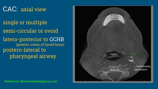 Soft tissue calcification in the neck | PPT