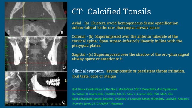 Soft tissue calcification in the neck | PPTX