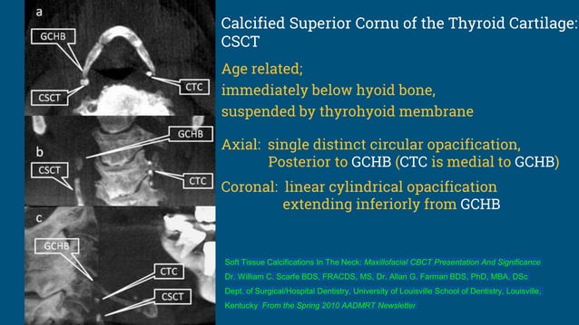 Soft tissue calcification in the neck | PPTX
