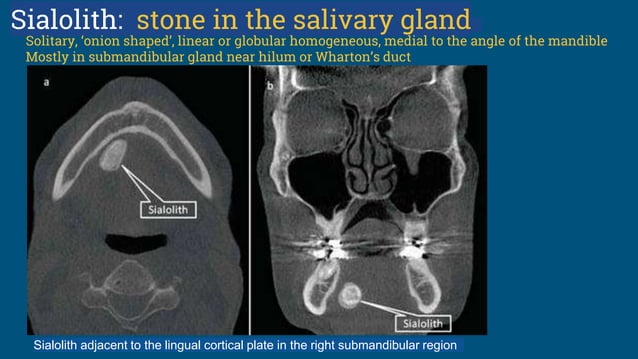 Soft tissue calcification in the neck | PPTX