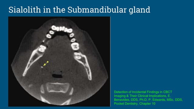 Soft tissue calcification in the neck | PPTX