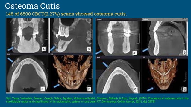 Soft tissue calcification in the neck | PPTX