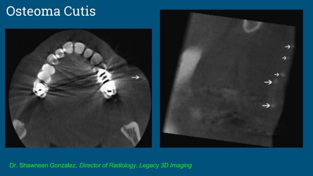 Soft tissue calcification in the neck | PPTX