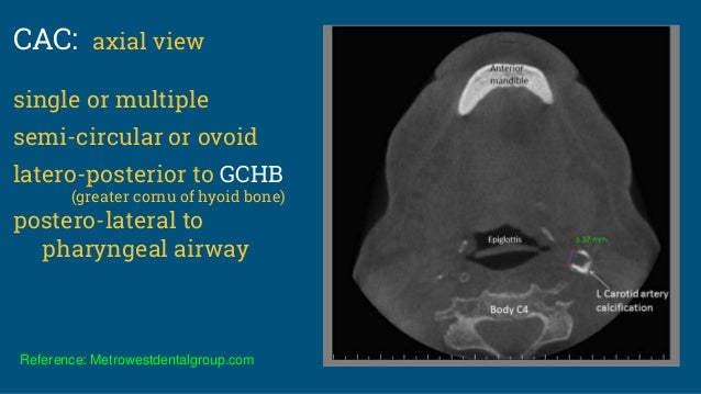 Chondrocalcinosis Vs Normal