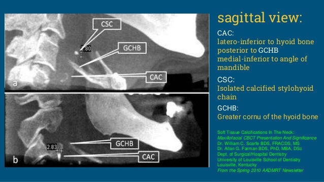 Soft tissue calcification in the neck