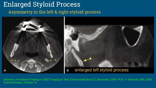 Soft tissue calcification in the neck