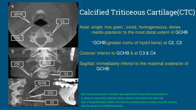 Soft tissue calcification in the neck