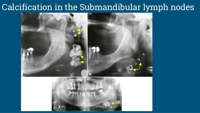 Soft tissue calcification in the neck