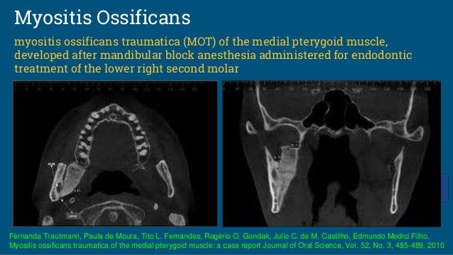 Soft tissue calcification in the neck