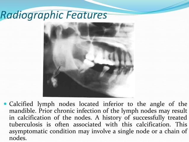 Soft tissue calcification of head and neck | PPTX | Ear, Nose and ...