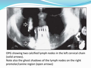 Soft tissue calcification of head and neck | PPTX