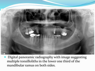 Soft tissue calcification of head and neck | PPTX