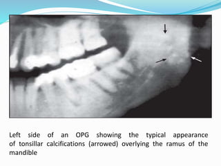 Soft tissue calcification of head and neck | PPTX