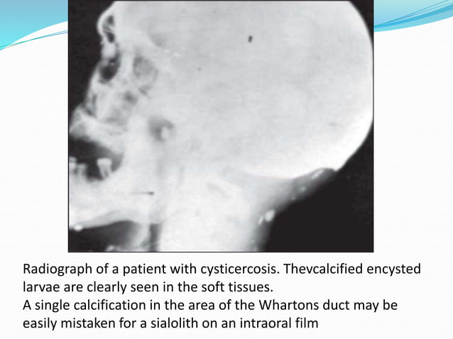 Soft tissue calcification of head and neck | PPTX | Ear, Nose and ...