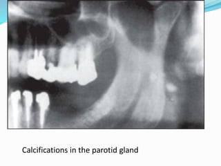 Soft tissue calcification of head and neck | PPTX