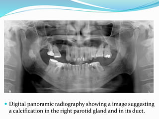 Soft tissue calcification of head and neck | PPTX