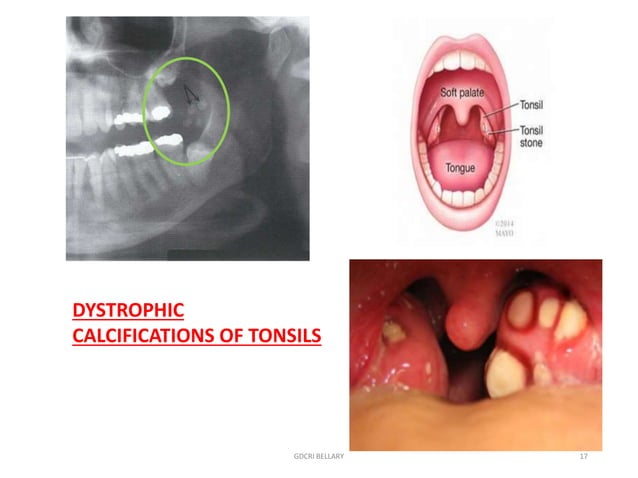 abnormal calcifications in head and neck region also with oral tissues ...