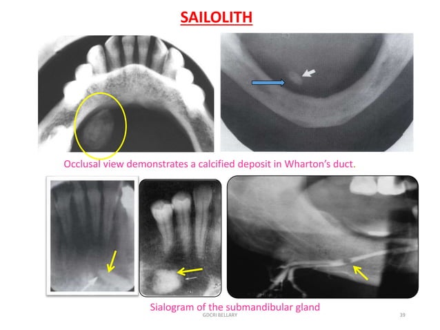 abnormal calcifications in head and neck region also with oral tissues ...